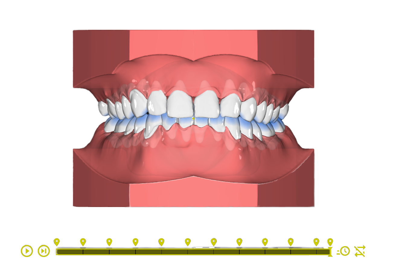 Premium Aligner Package | 3Dental